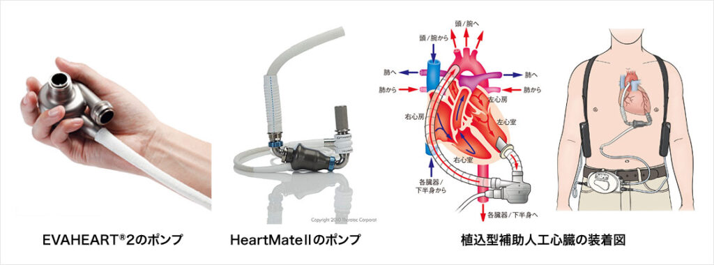 補助人工心臓（VAD）とは？ | 筑波大学附属病院 茨城県脳卒中・心臓病等総合支援センター
